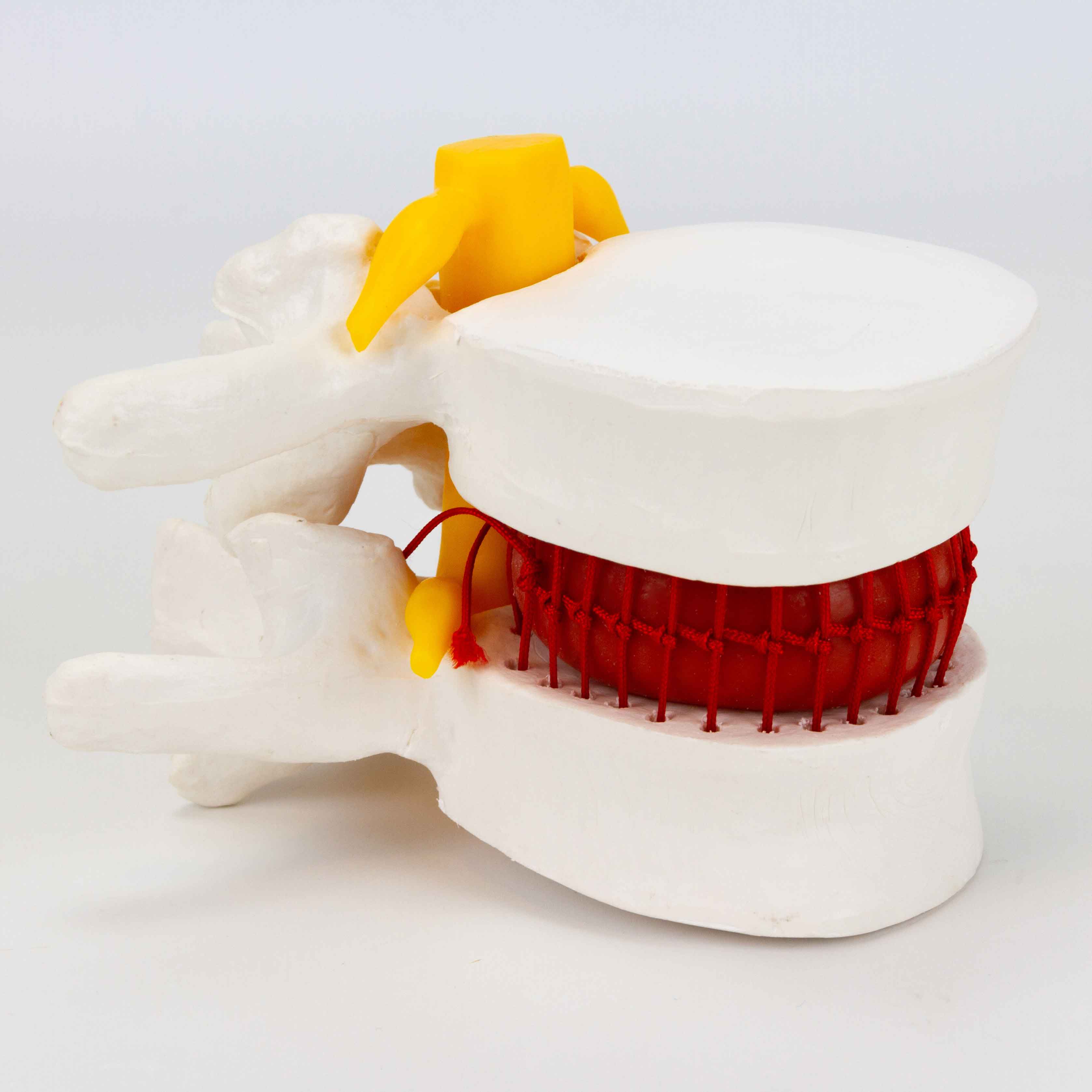 Herniated Disc Demonstration Model [SKU: MG35510] – Nasco Healthcare