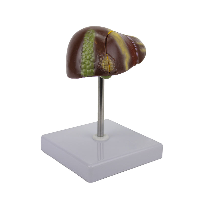 Liver Section with Pathology Model, 2 Parts [SKU: MG23415] – Nasco ...