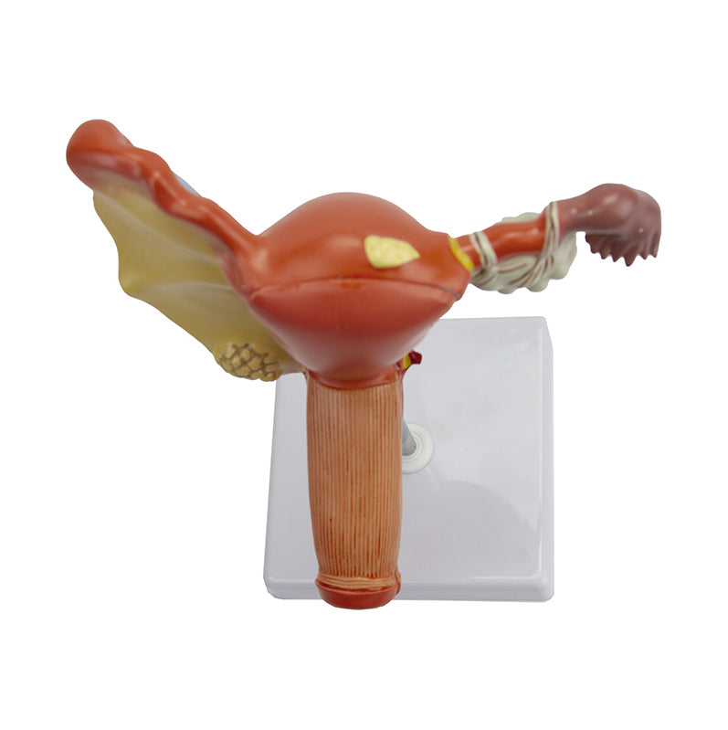 Female Genital Organ with Pathology Model, 2 Parts [SKU: MG29947 ...