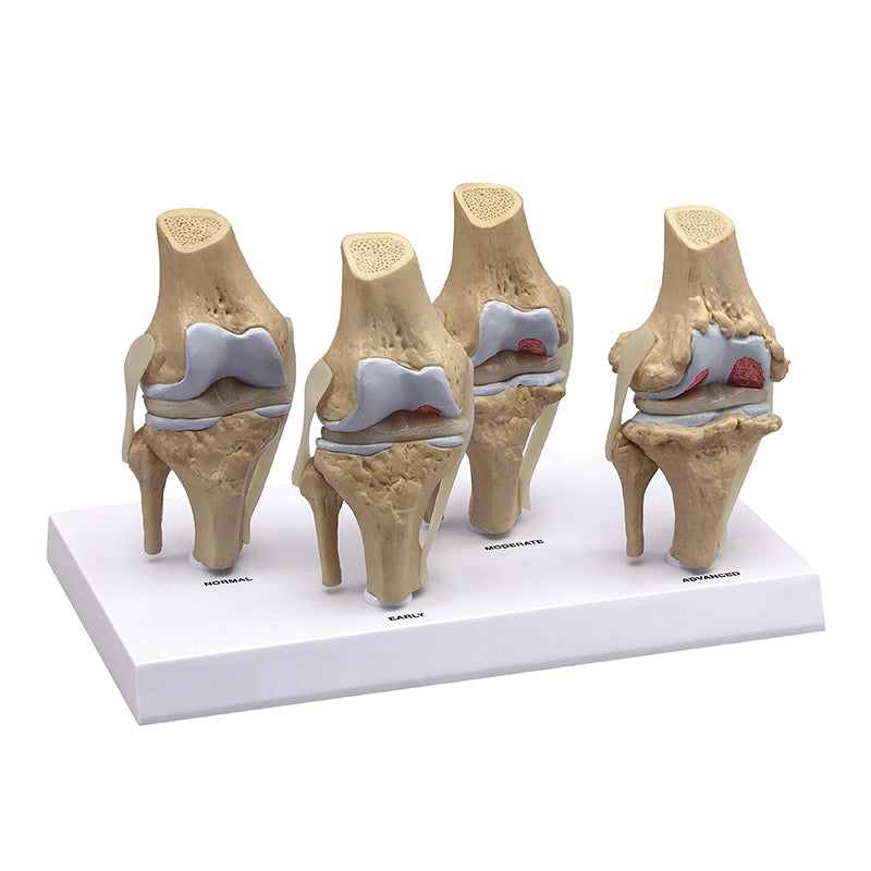 Knee Joint with Pathologies Model, 4-Stages [SKU: MG20228] – Nasco ...