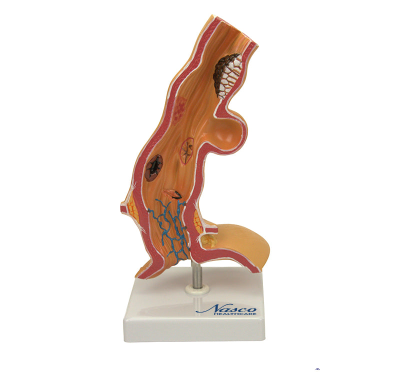 Esophageal Disease Model, 5X Enlarged – Nasco Healthcare