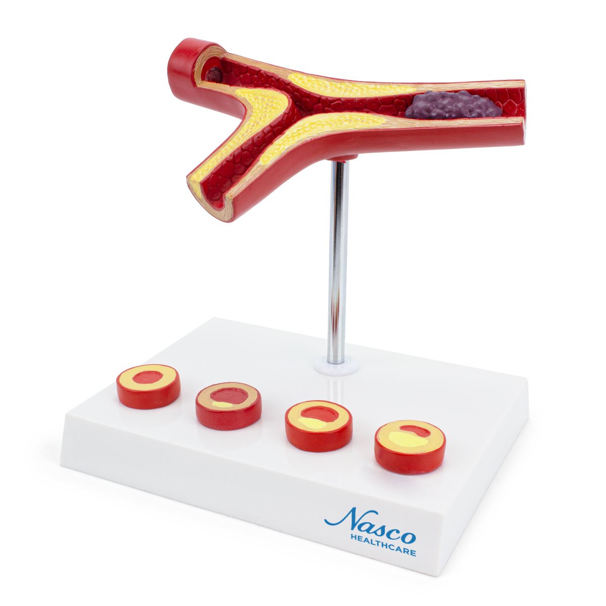 Arteriosclerosis & Thrombosis with Artery Cross Section Model – Nasco ...