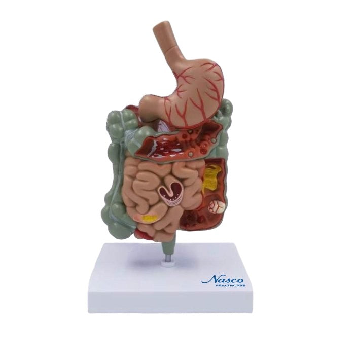 Gastrointestinal Tract with Pathologies Model – Nasco Healthcare