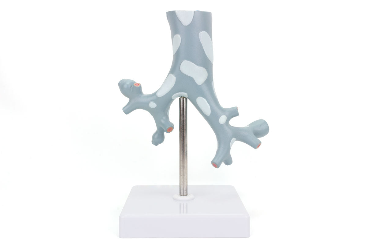 Bronchial Tree Section with Pathology Model, 10X Enlarged [SKU: MG3109 ...