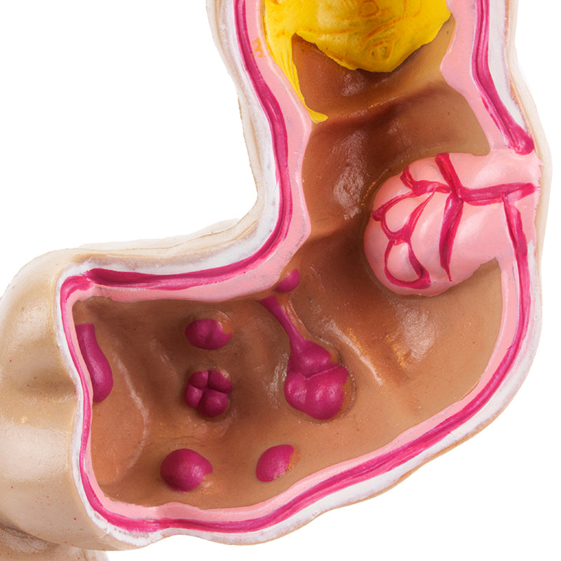 Colon with Intestinal Pathologies Model [SKU: MG21850] – Nasco Healthcare